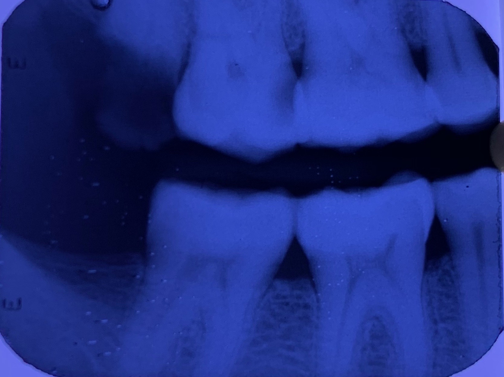 bitewing_ori_sag Object Detection Dataset by deneme