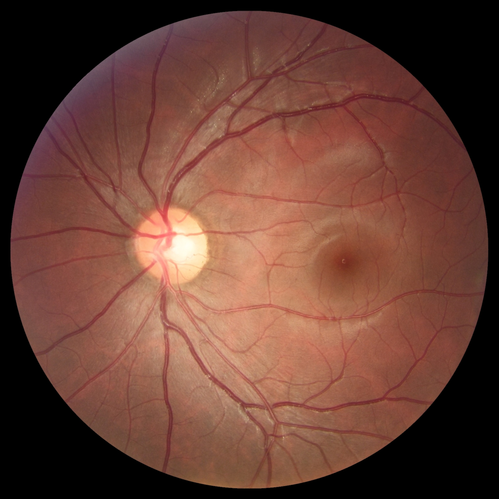 Glaucoma Object Detection Model by Than Quan Nguyen