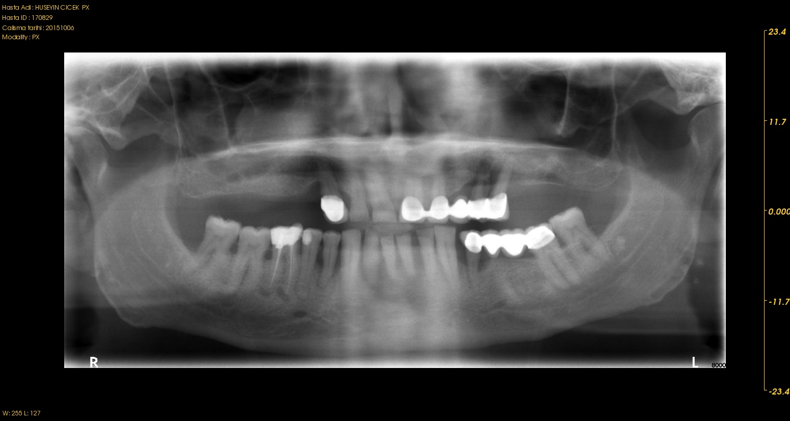 Lezyondetection Object Detection Dataset And Pre Trained Model By Serkan Yldz