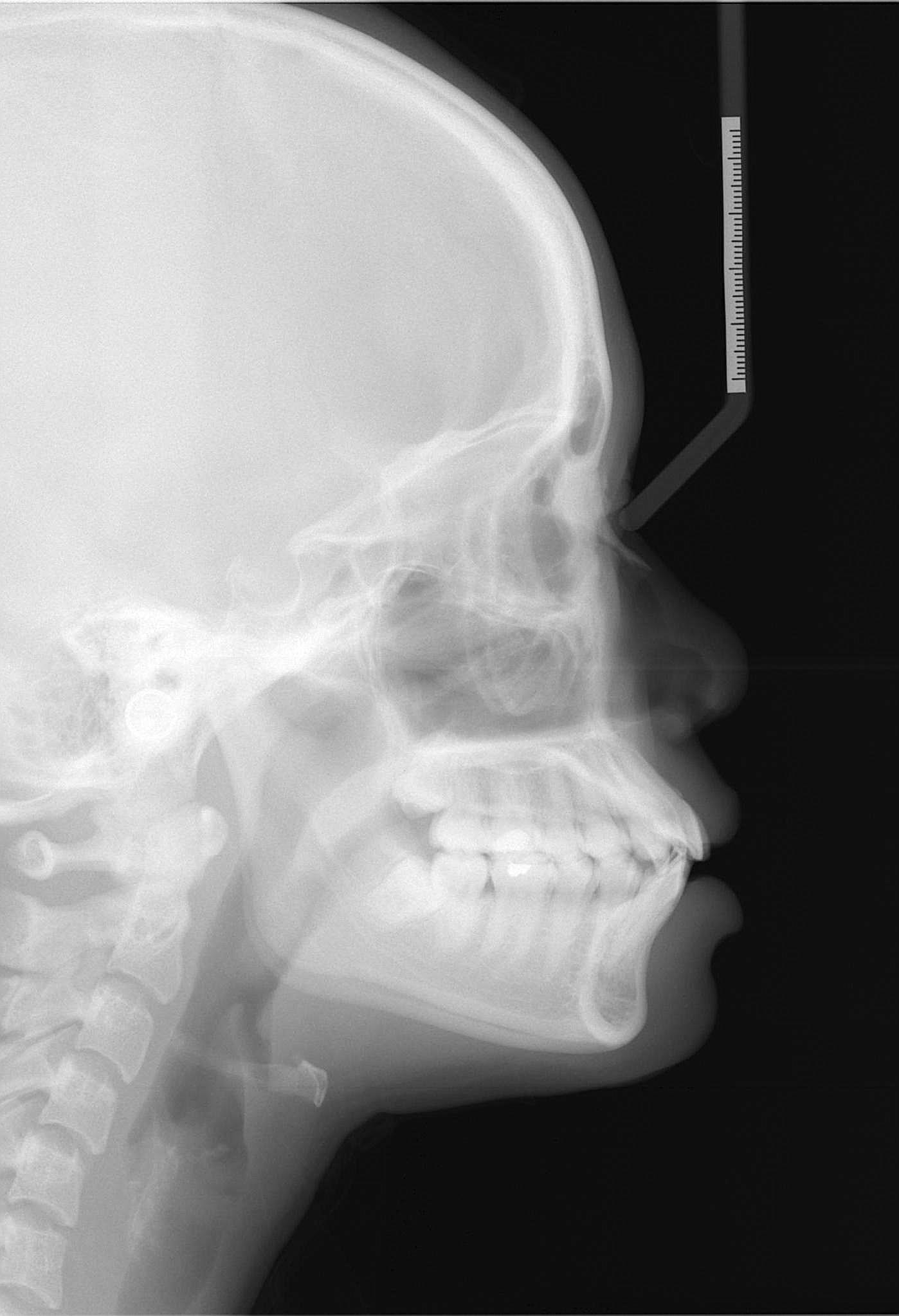 Ori Object Detection Dataset By Malocclusion