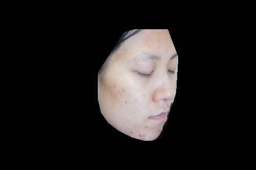acne_ggr Classification Dataset by faceLab001