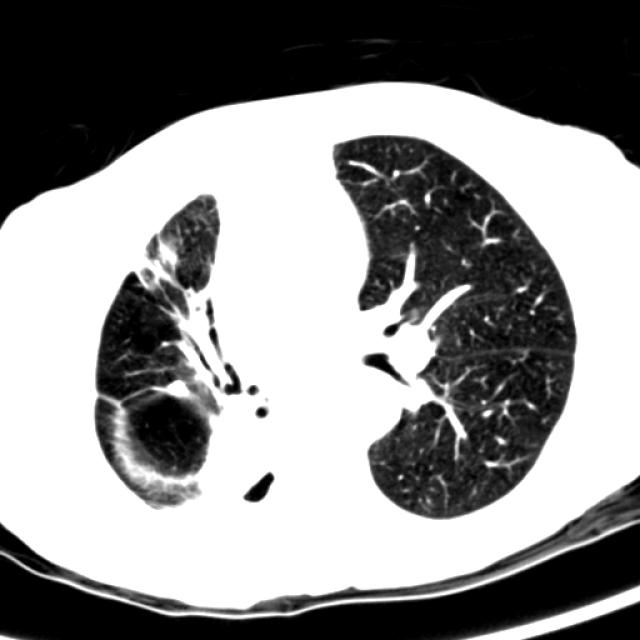 Lung Cancer Dataset Object Detection Dataset By Mendozajpd
