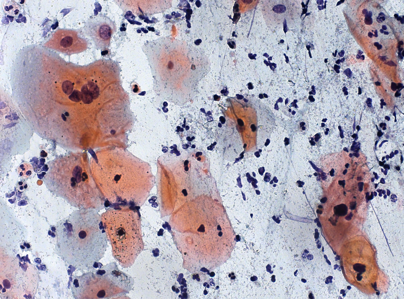 LSIL Object Detection Dataset by Cervical Cancer