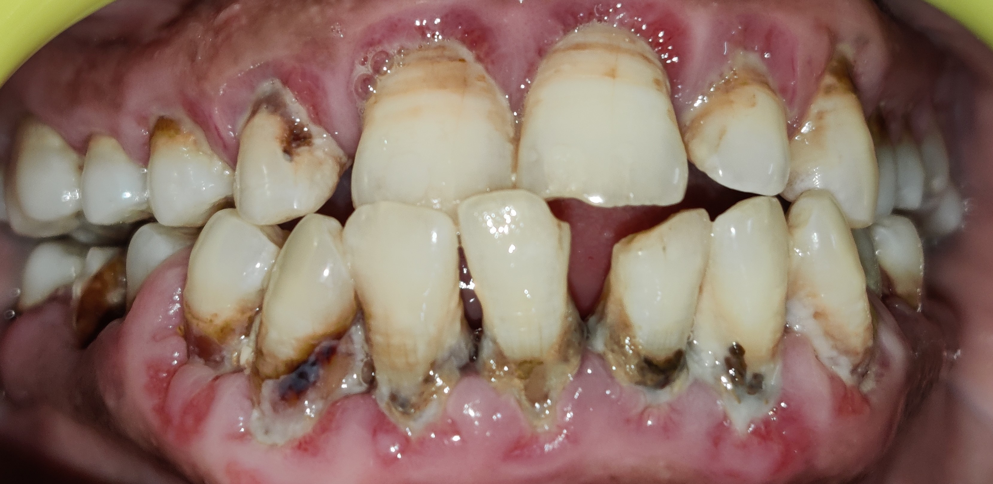 Calculus Object Detection Model by Arrythmia
