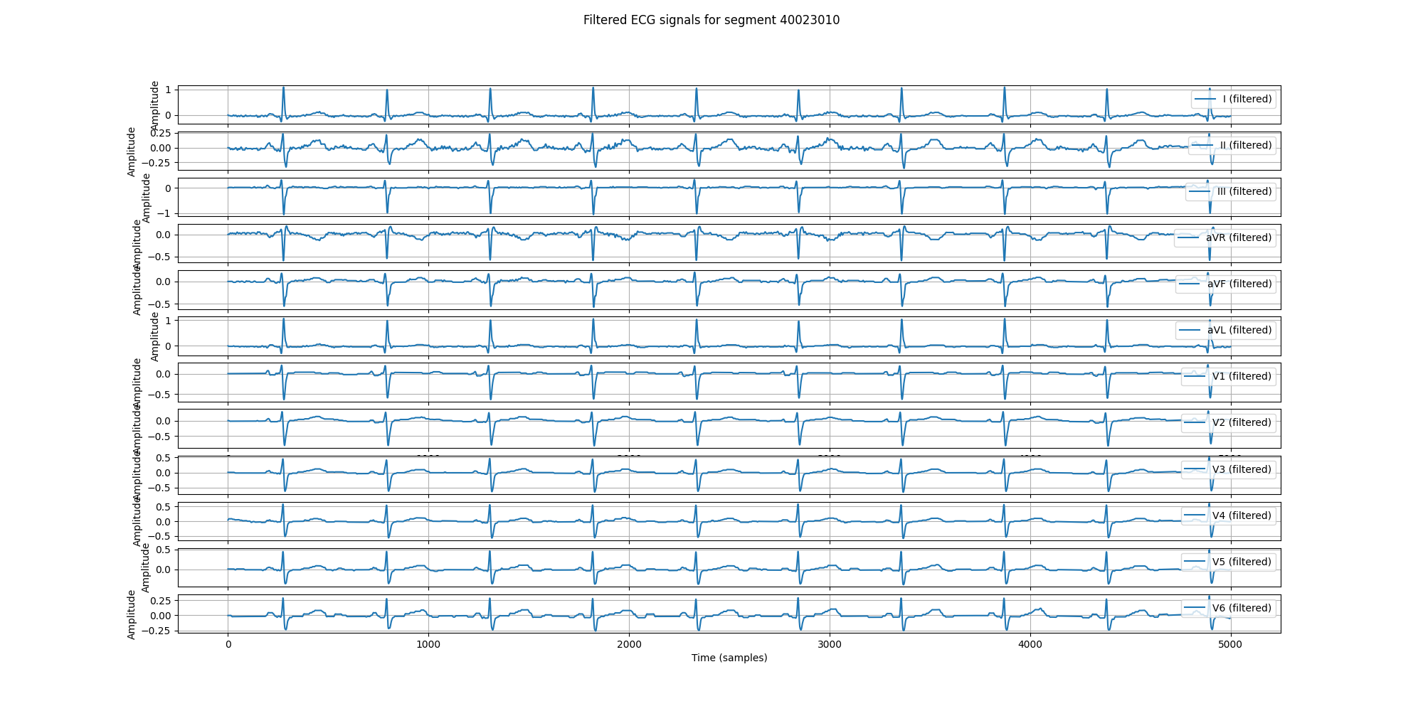 Hyperkalemia-Severe Classification Dataset by Arrythmia