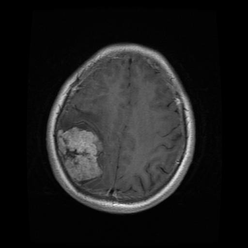 Brain Tumor Object Detection Dataset And Pre Trained Model By Brain
