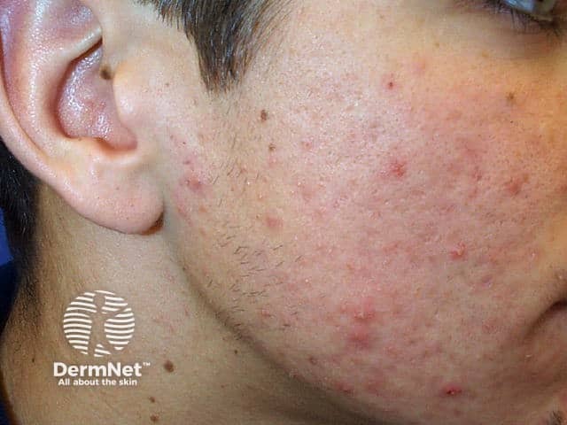 How to Use the Acne Detect Object Detection API