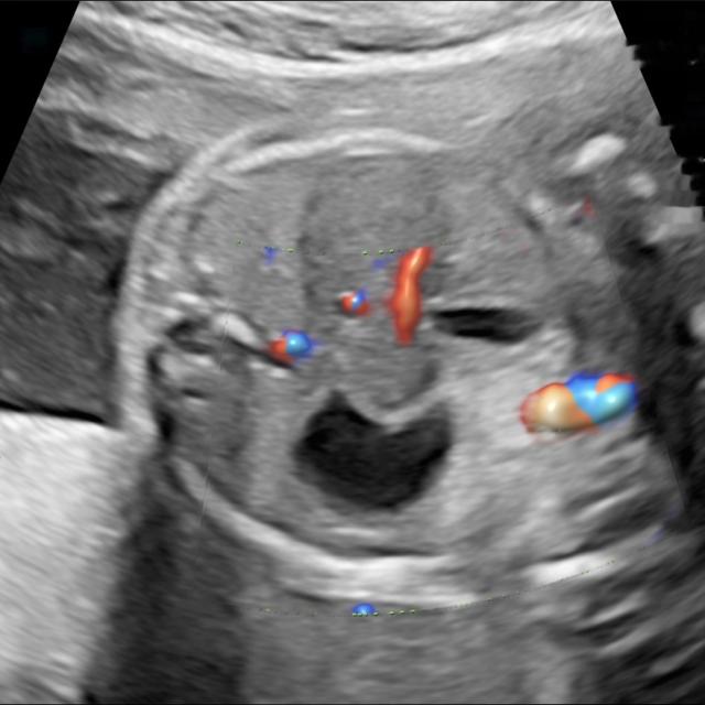 gallstones Classification Model by sushiltamang