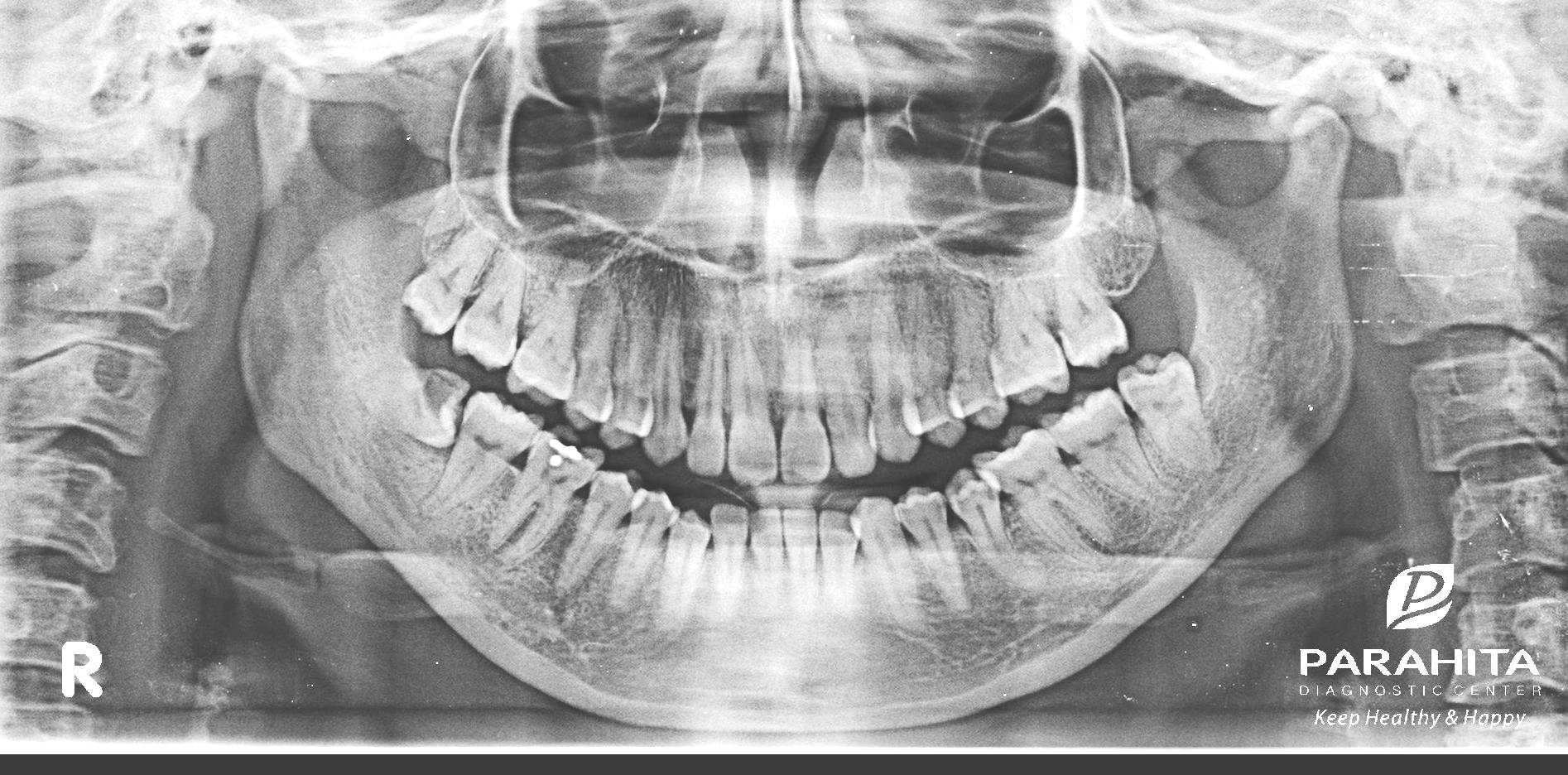 Toothdetectionaugmented Object Detection Dataset And Pre Trained Model