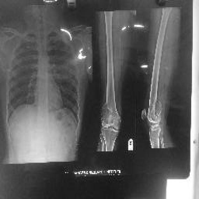 Bone Cancer Detection Object Detection Dataset By Udg