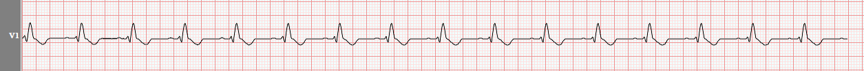 ECG 3 Classification Dataset and Pre-Trained Model by ECG