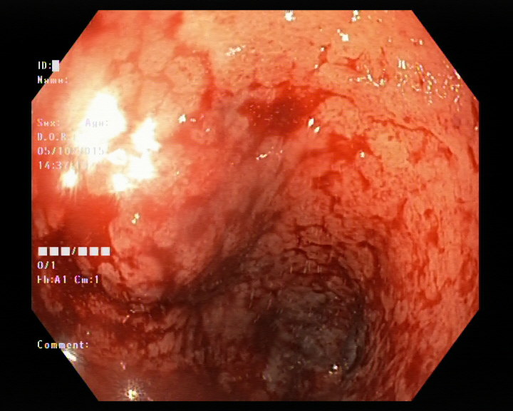 Kvasir V2 Classification Model by Kvasir V2