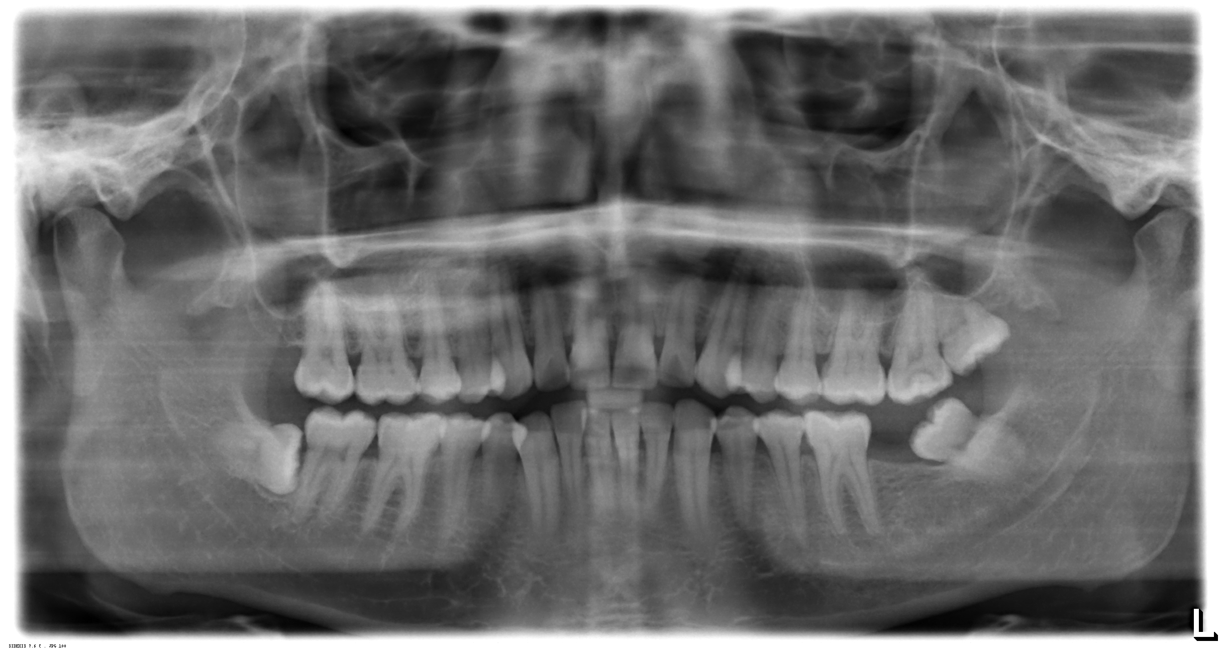 How to Use the tooth Instance Segmentation API