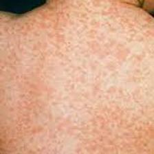 Monkeypox detection Object Detection Dataset and Pre-Trained Model by lokesh