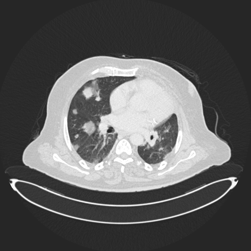 Tumor Detection Object Detection Dataset by Tomatoes
