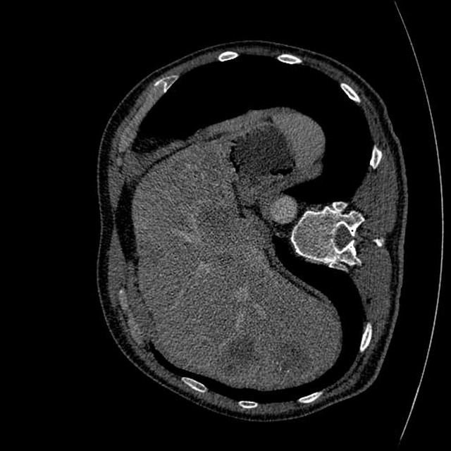 Liver Tumor Segmentation Instance Segmentation Dataset And Pre Trained Model By Amanda Salsabila