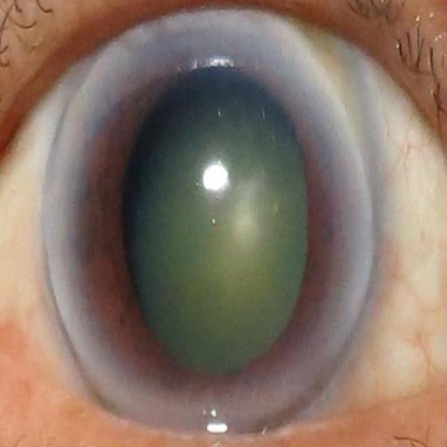 eyes disease Instance Segmentation Dataset by cpcs432