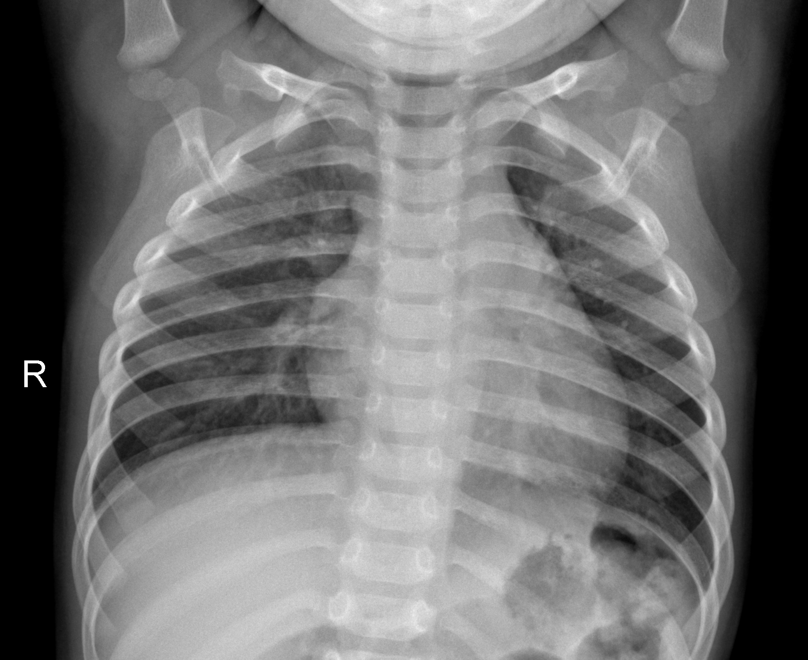 Cxr pneumonia Classification Model by Text Ju AOCR