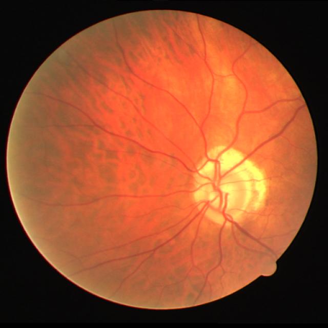 retinal vessel segmentation Instance Segmentation Dataset and Pre ...