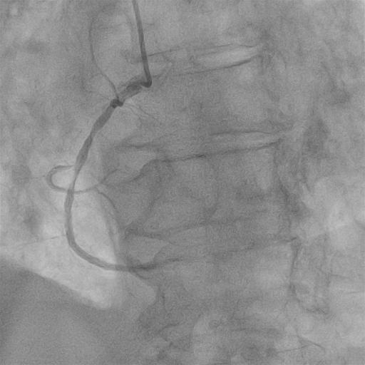 coronary disease stenosis detect Instance Segmentation Model by Finalthesis