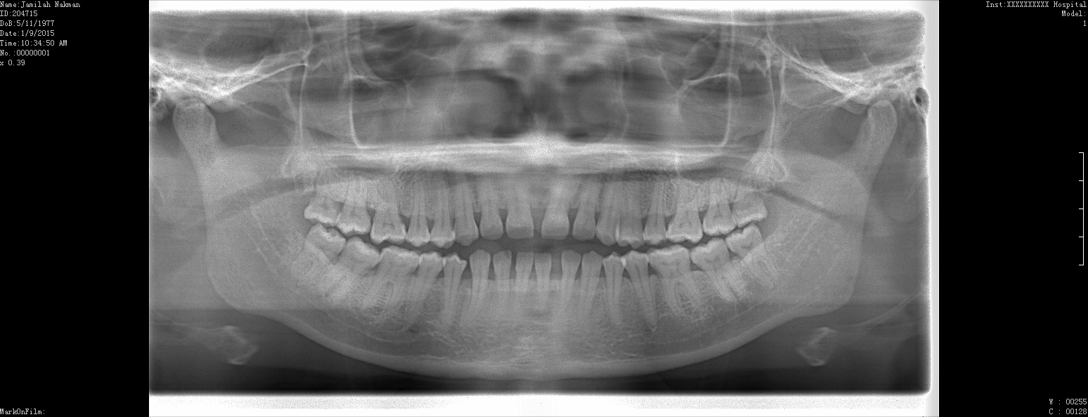 teeth-detection-and-numbering Object Detection Dataset and Pre-Trained Model by University of Malaya