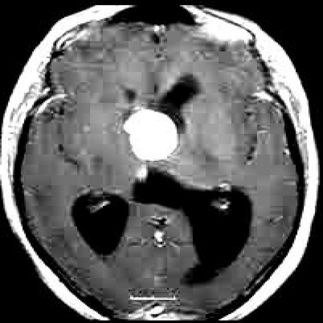 Brain Tumor Detection Object Detection Model by Ishitas Plan