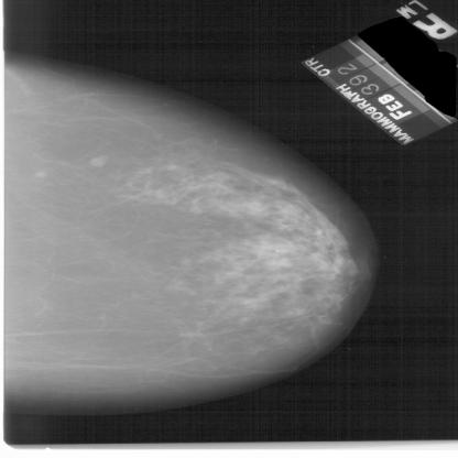 How to Use the breast cancer detection Object Detection API