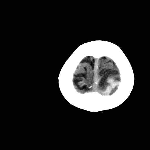 Brain Stroke Instance Segmentation Dataset by brainstrokectdata