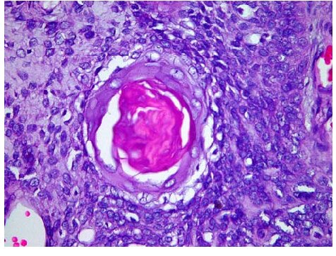 SQUAMOUS CELL LUNG CARCINOMA Classification Dataset and Pre-Trained ...