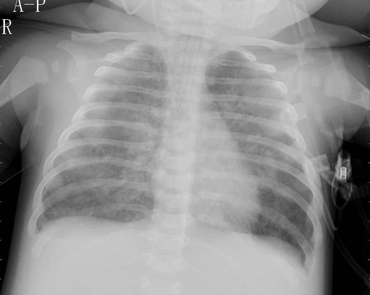 chest x ray Classification Model by Tangmo Watermelon