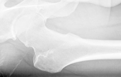 Hip Joint Detection Roboflow Universe