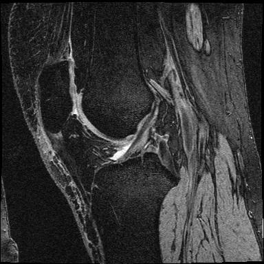 OAI-Sagittal Object Detection Model by OAI