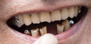 space between teeth Object Detection Model by MNIT jaipur