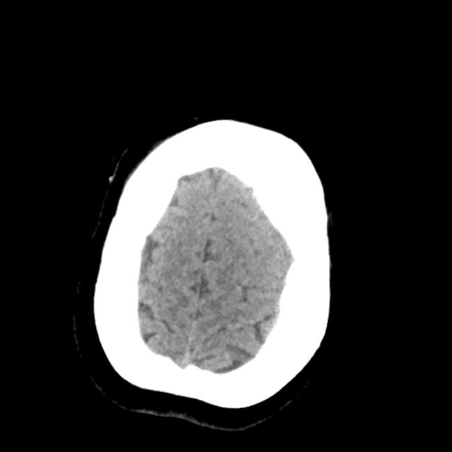 Stroke Detection Object Detection Model by Stroke Detection