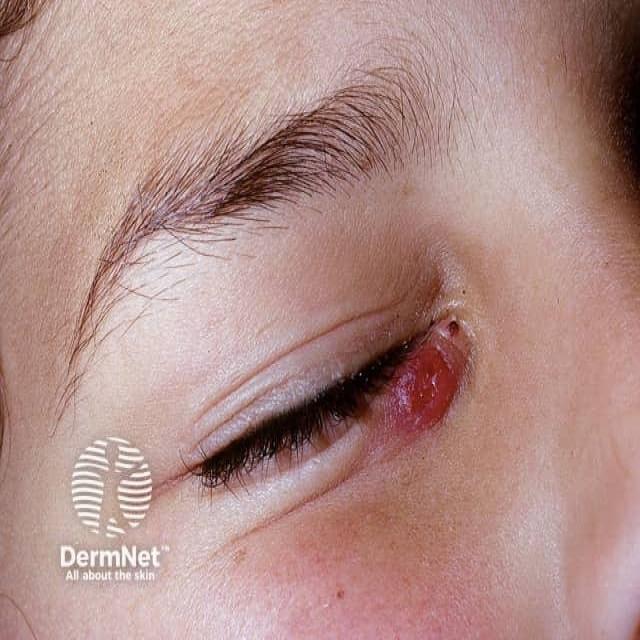 Lupus Detections Object Detection Dataset And Pre Trained Model By Nour