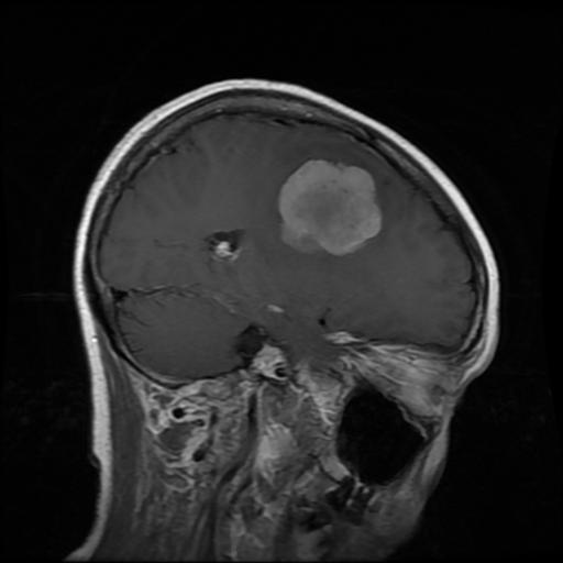 Brain Tumor Detection Object Detection Dataset And Pre Trained Model By