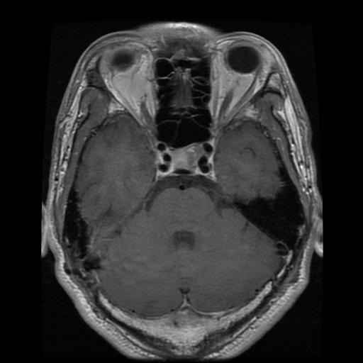 Brain tumor Object Detection Model by S Berlin Shaheema Research ...