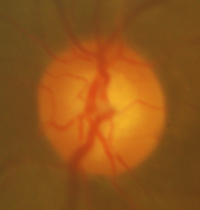 Optic Disc Instance Segmentation Dataset by EyedragonPMD