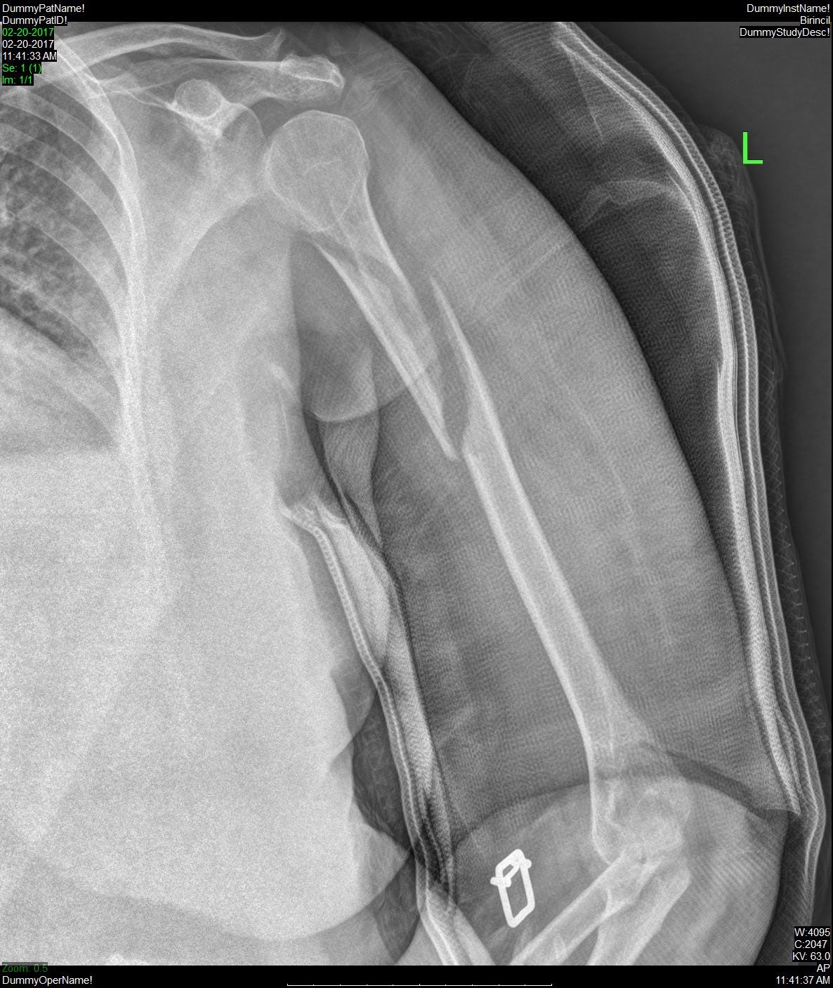 Humerus-2 Object Detection Dataset by Graduation