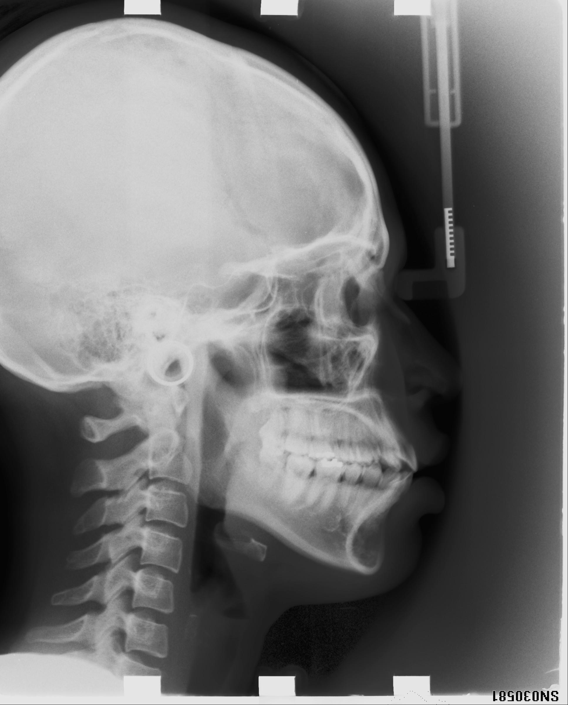 cephalometric landmarks Object Detection Model by CEPHALO