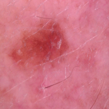 Cancer Object Detection Dataset and Pre-Trained Model by Photo