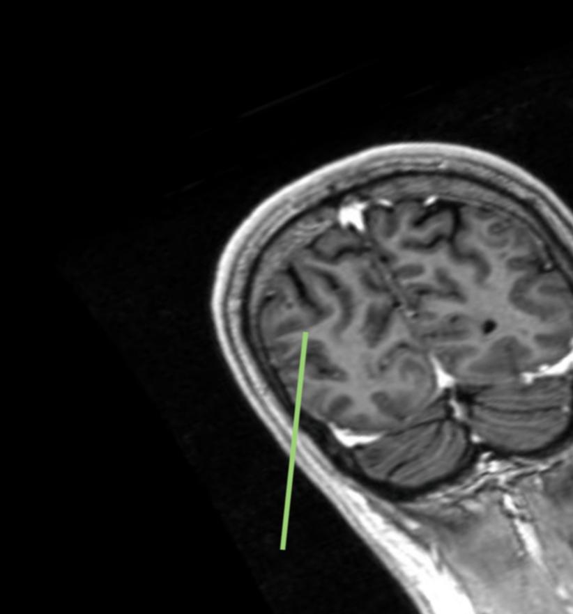 Coronal Scalpel MRI Instance Segmentation Model by Aniket Tadinada
