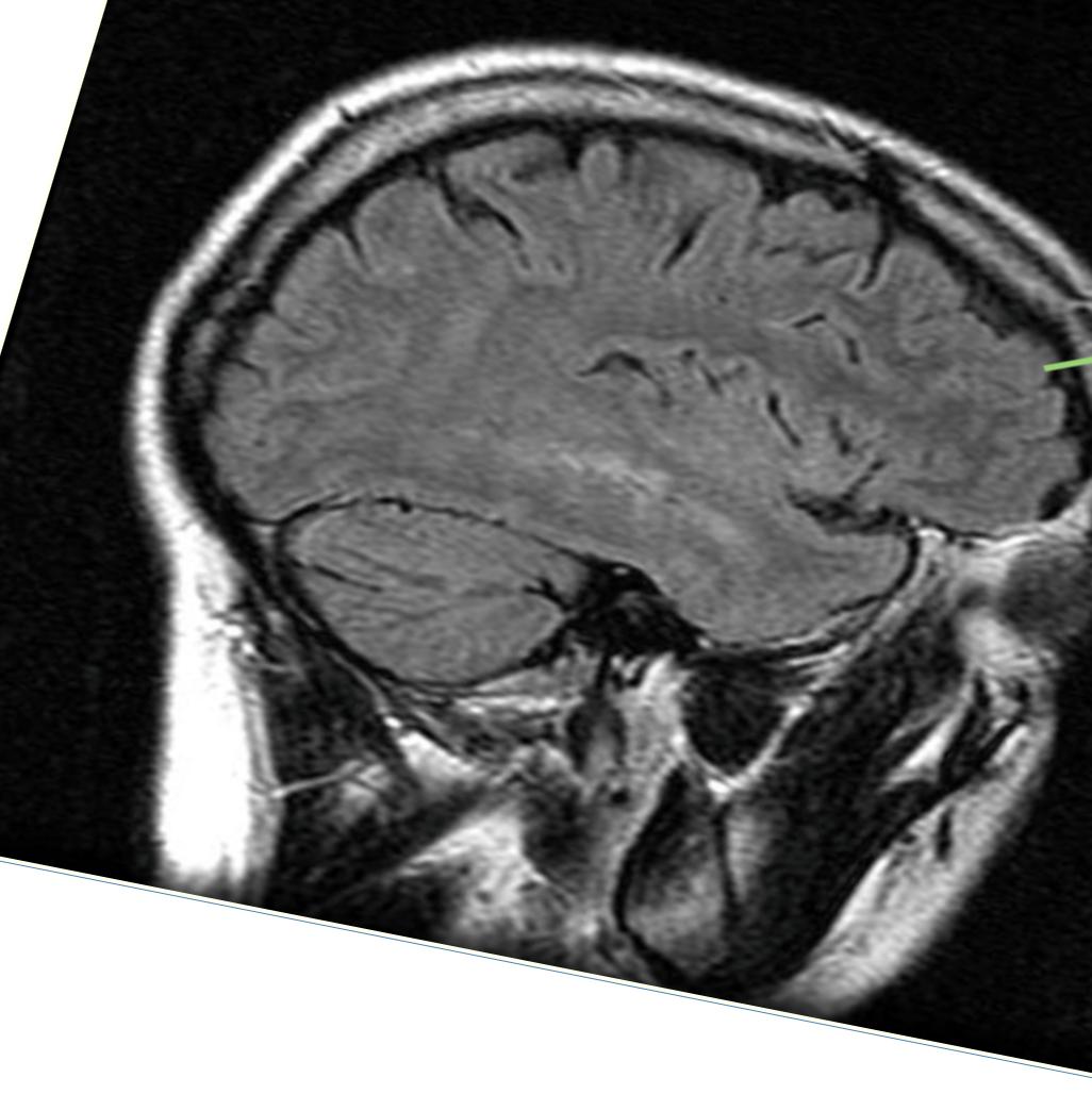 Scalpel Sagittal MRI Instance Segmentation Model by Aniket Tadinada