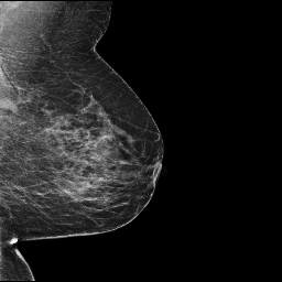 Mammography Breast Cancer Dataset - Roboflow Universe