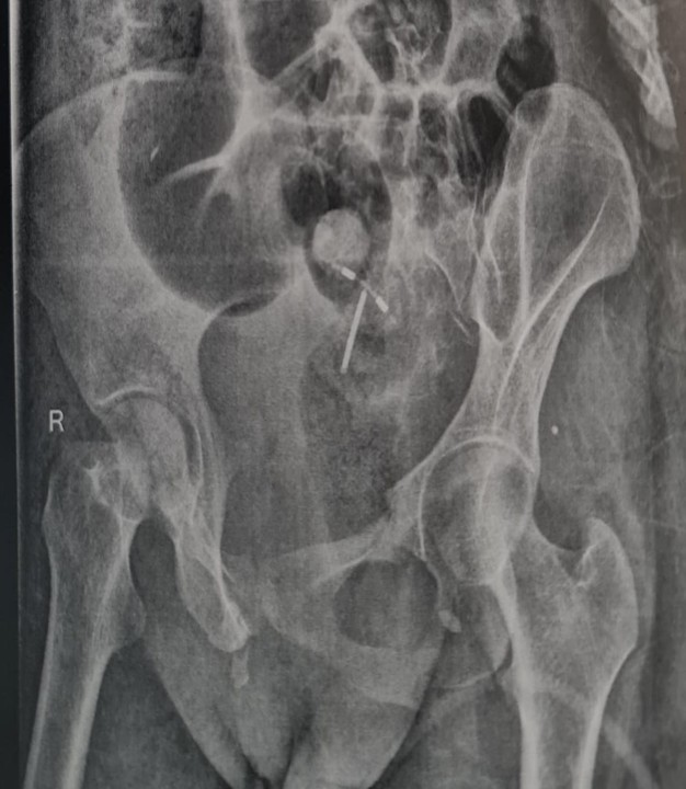 Pelvic Fractures Real Dataset Object Detection Dataset And Pre Trained Model By Pelvic Fractures