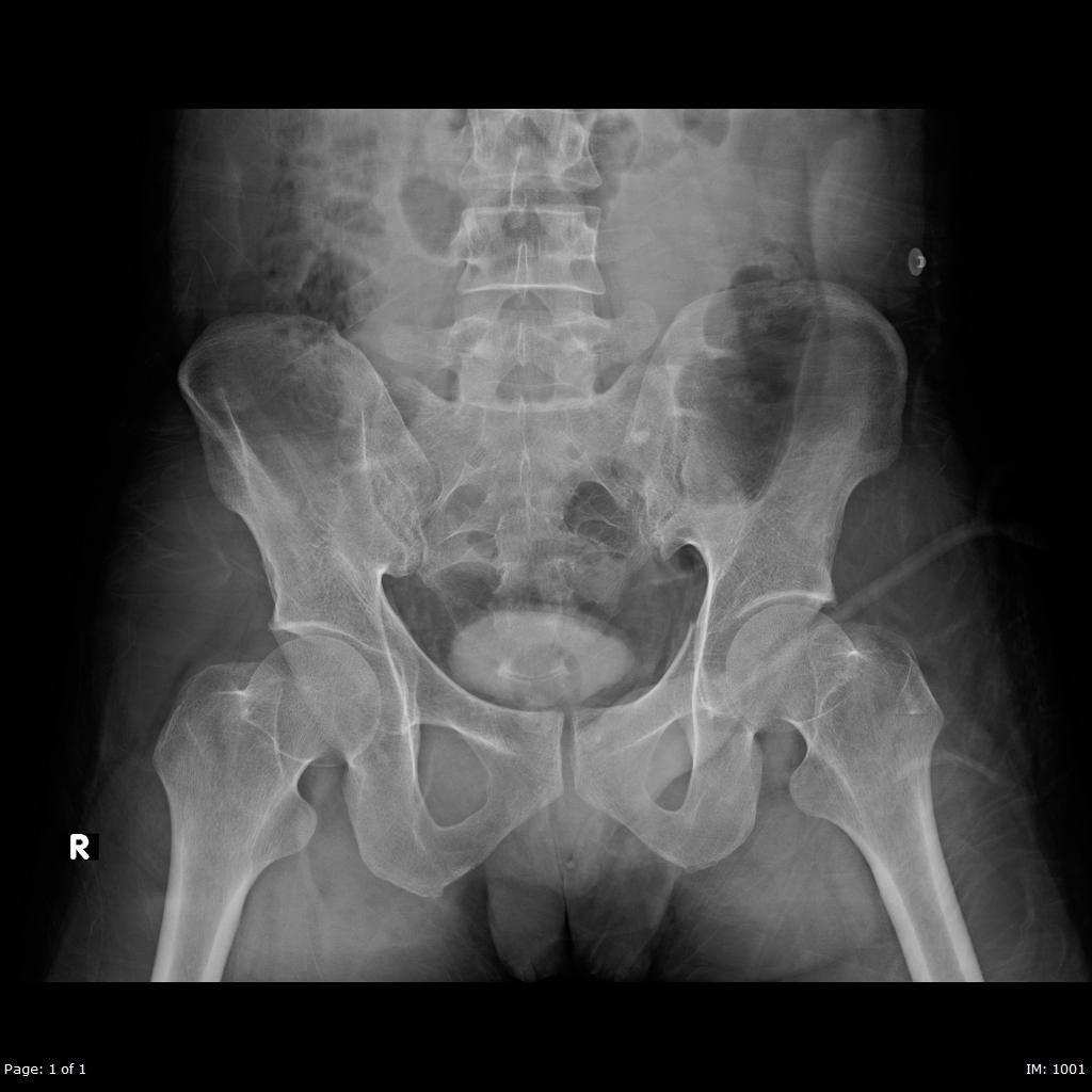 Pelvic Fractures Object Detection Dataset By Pelvic Fractures