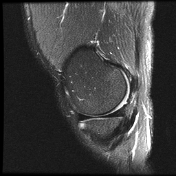 meniscal Object Detection Model by isimg