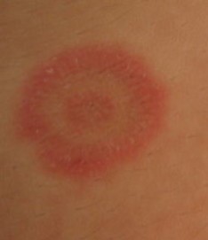 SKIN disease Instance Segmentation Model by ship