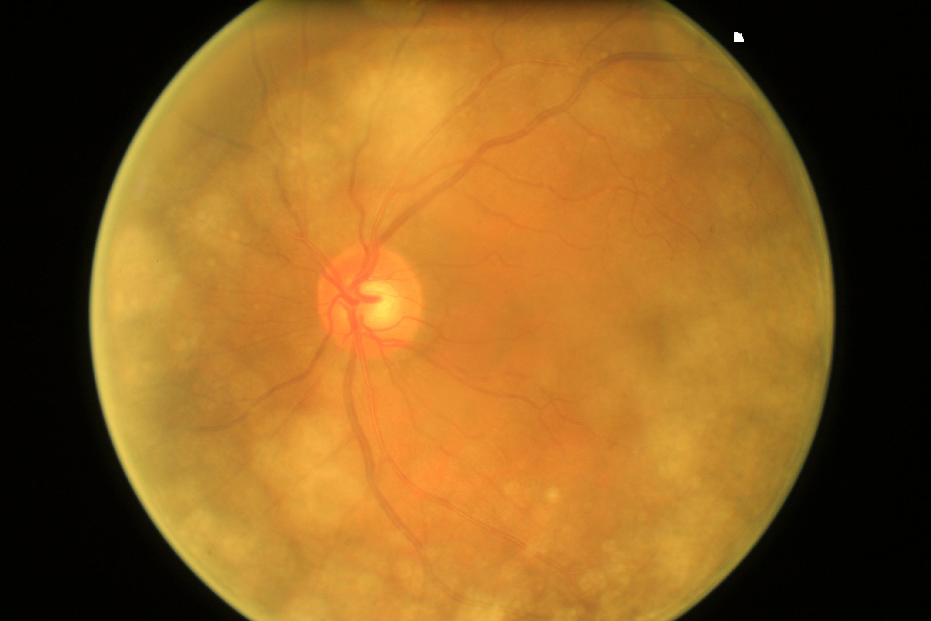 Glaucoma Dataset Classification Dataset By Data