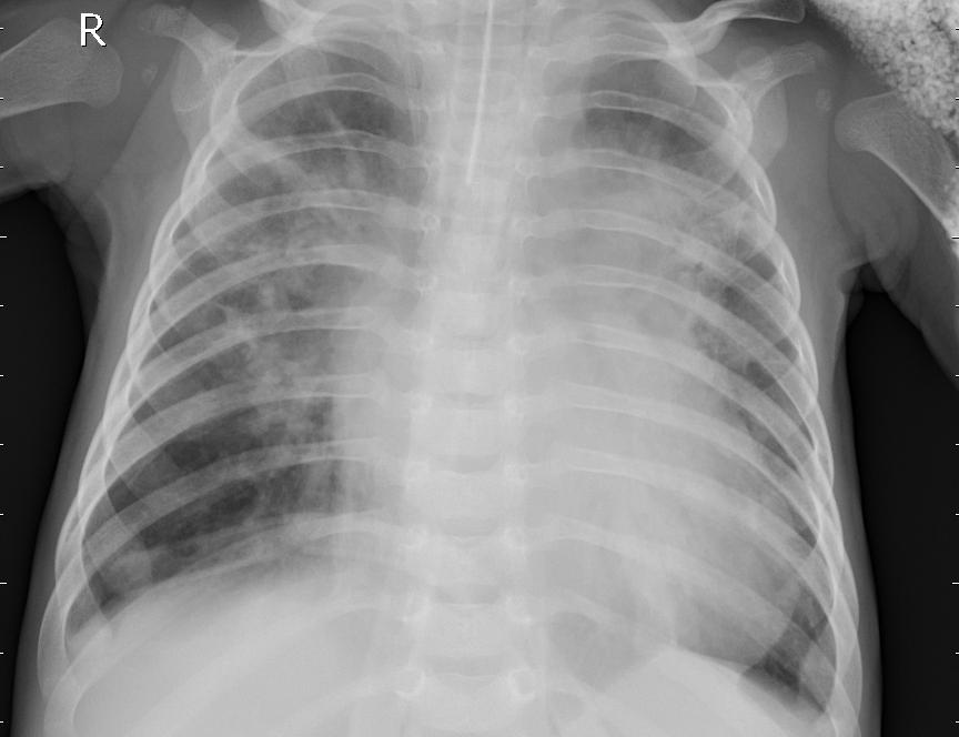 classification of pneumonia and normal patients Classification Model by ...